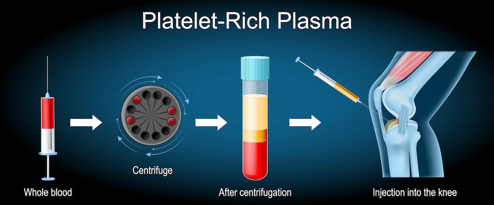 Plasma Rich Platelets (PRP) and Plasma Rich Fibrin (PRF) - Anderson Integrative Medicine